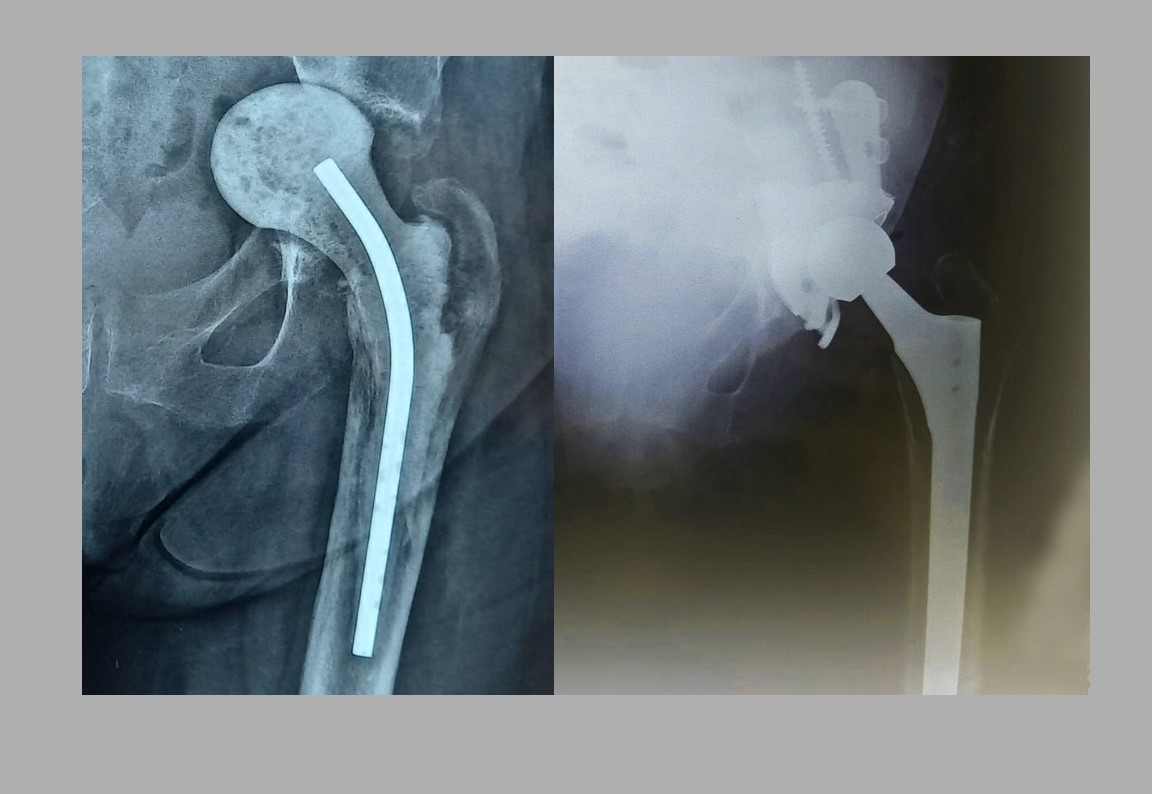 An example of revision endoprosthesis of the hip joint